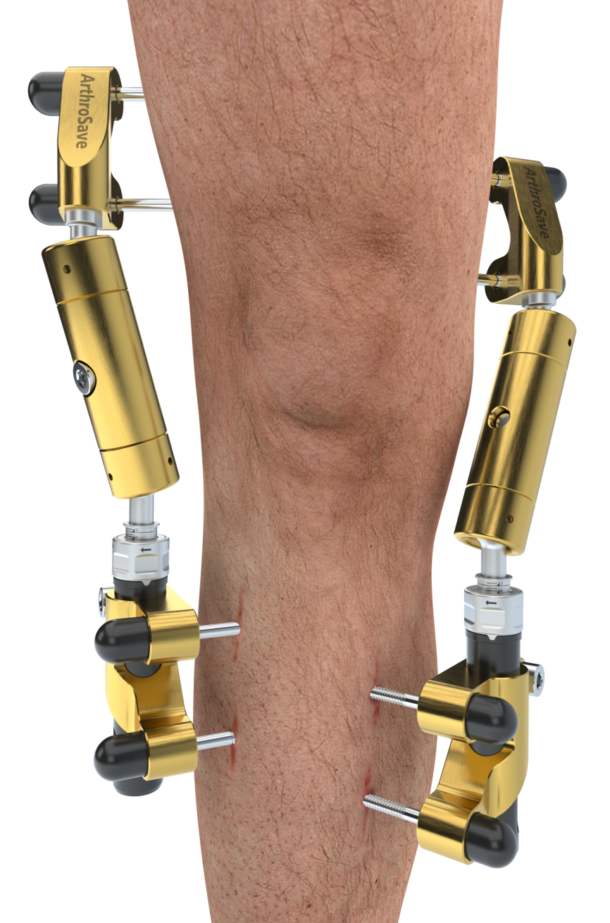 Kniedistractie voor artrose in ziekenhuizen | ReumaNederland